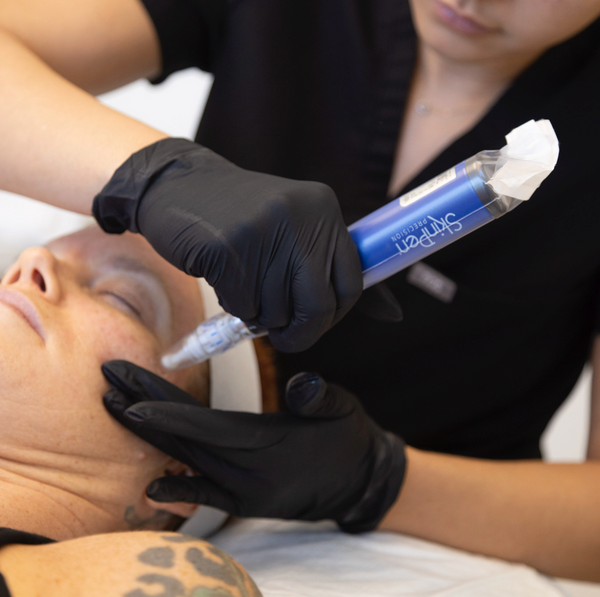 Why We Love SkinPen® Microneedling at Aloha Med Spa
