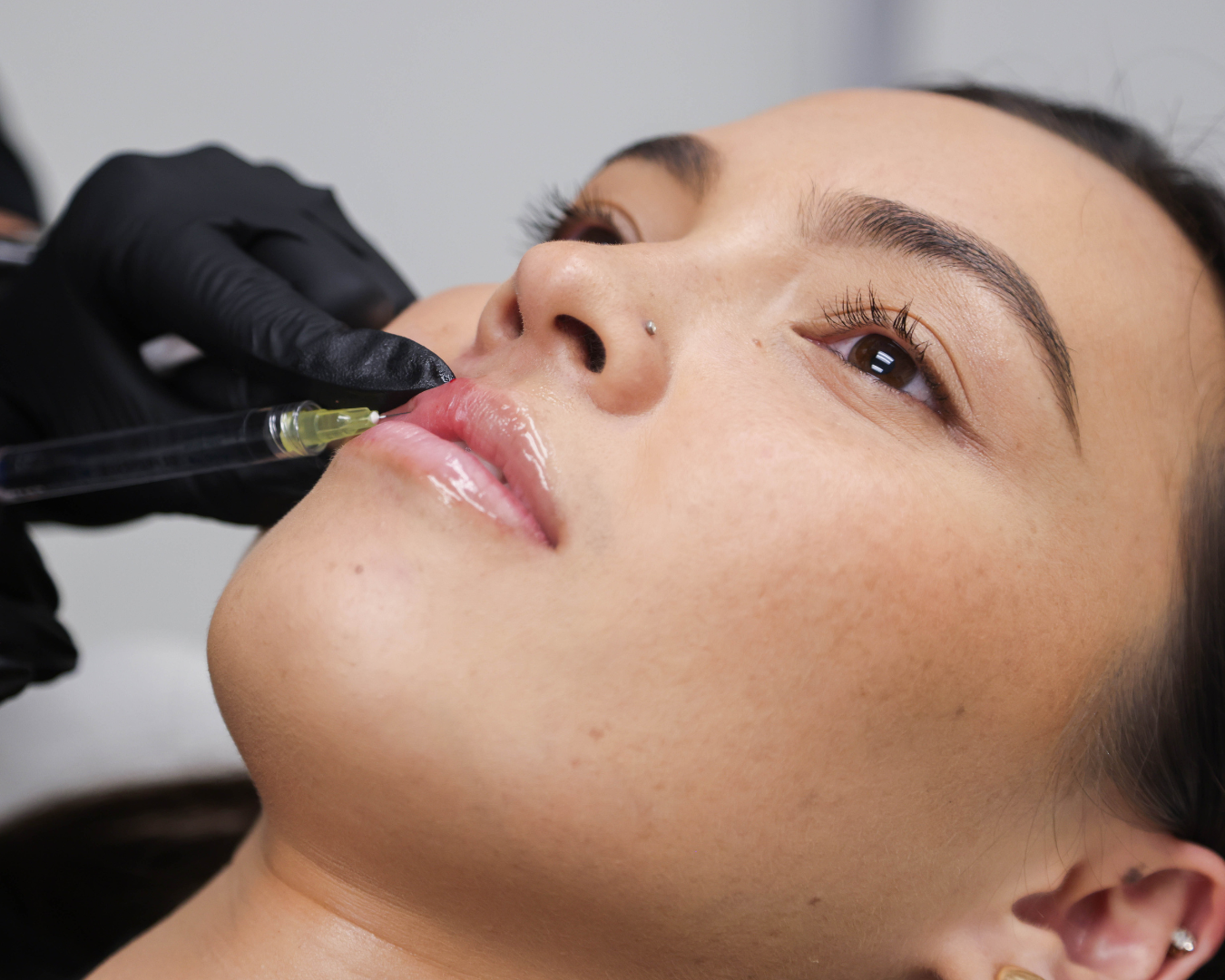Lip Filler – Aloha Med Spa