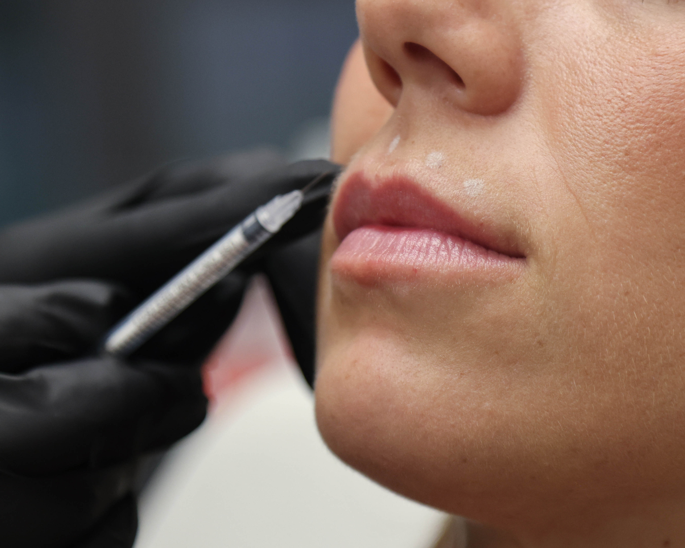 Lip Flip – Aloha Med Spa