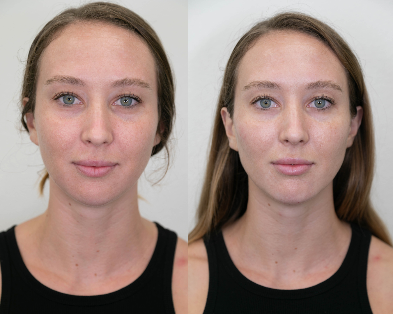 Facial Balancing – Aloha Med Spa