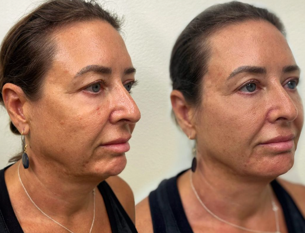 Temple Filler – Aloha Med Spa